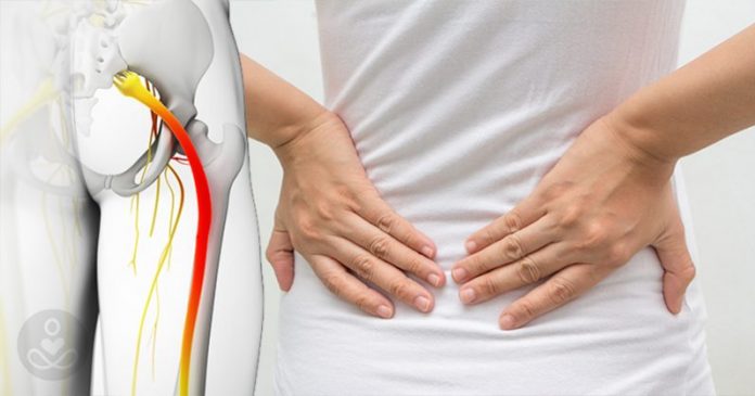 8 Mitos Sciatica ICD 10 yang Membuat Hidup Anda Berantakan – Lamina ...