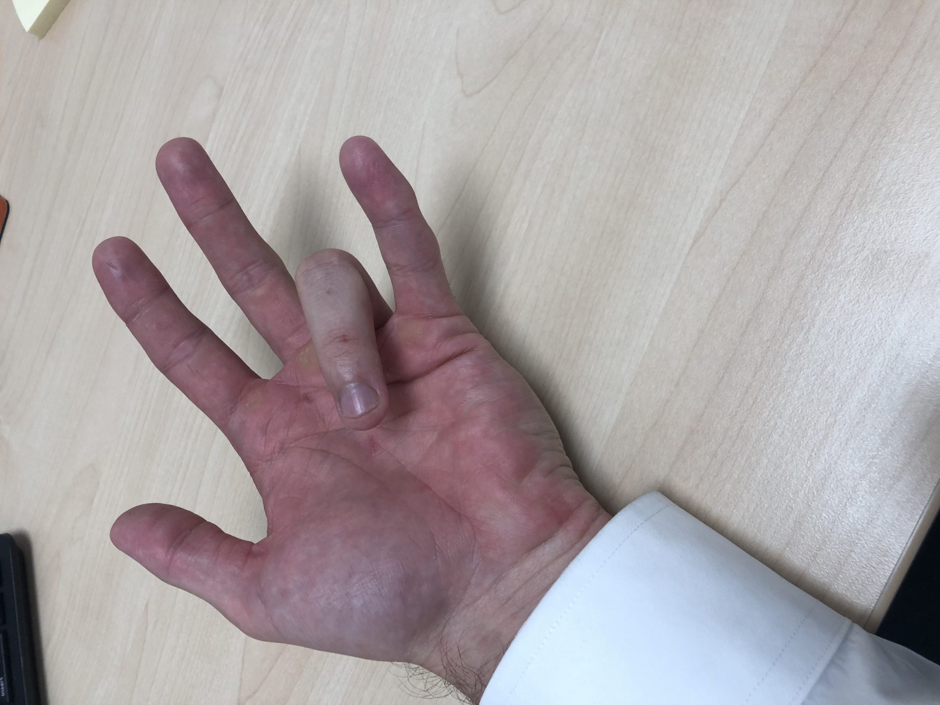 Jari Tangan Kaku Adalah Gejala Trigger Finger, Ini Terapinya - Lamina