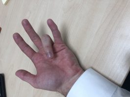 Jari Tangan Kaku Adalah Gejala Trigger Finger, Ini Terapinya - Lamina