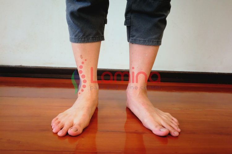 Bahaya Flat Foot Atau Telapak Kaki Datar Adalah – Lamina Pain and Spine ...