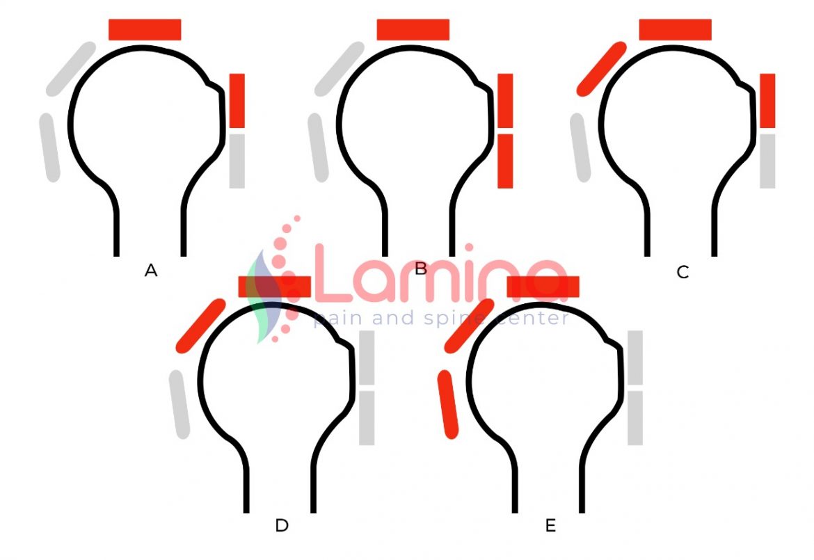 Rotator Cuff Tear Adalah Salah Satu Penyebab Nyeri Bahu – Lamina Pain ...